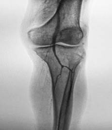 Trombolisis dirigida por catéter en paciente con oclusión arterial ...