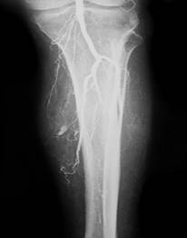 Trombolisis dirigida por catéter en paciente con oclusión arterial ...
